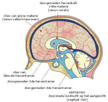 Hersendruk ten gevolge van hersentumor